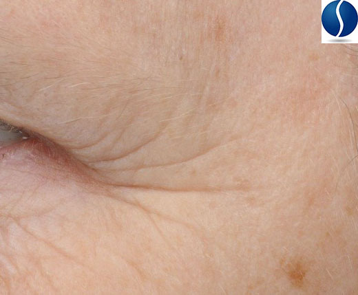 Using Image Analysis for the Detection and Evaluation of Wrinkles - SGS ...