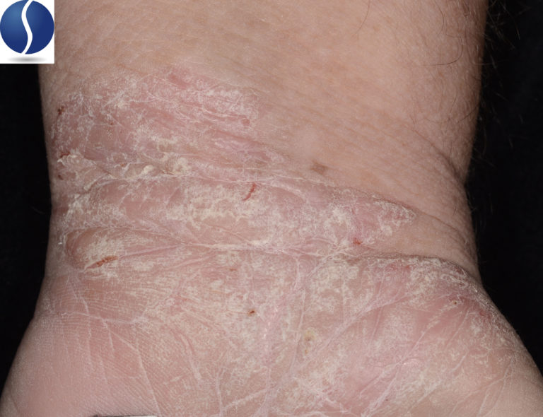Skin Conditions - SGS Clinical Studies