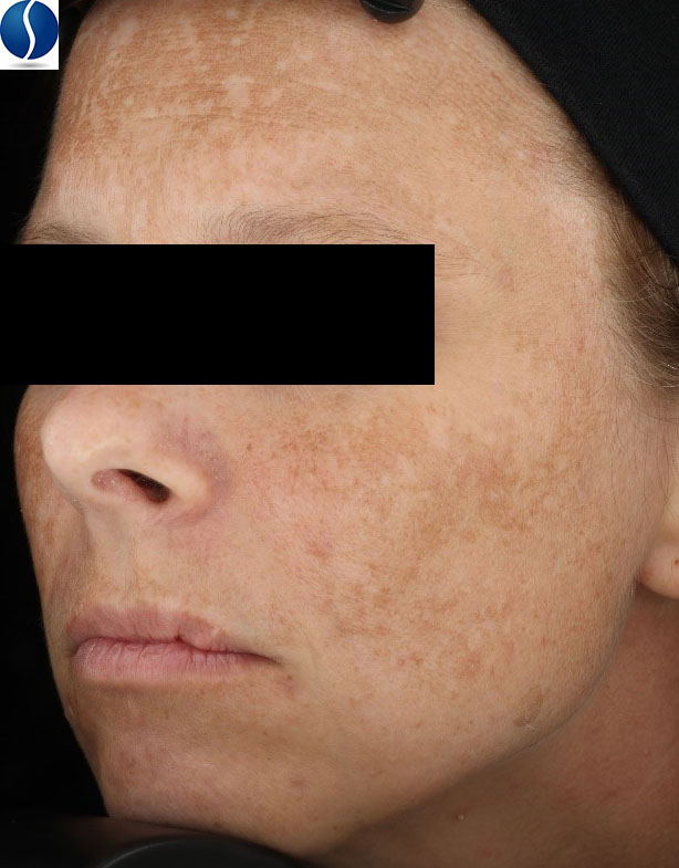 Skin Conditions - SGS Clinical Studies