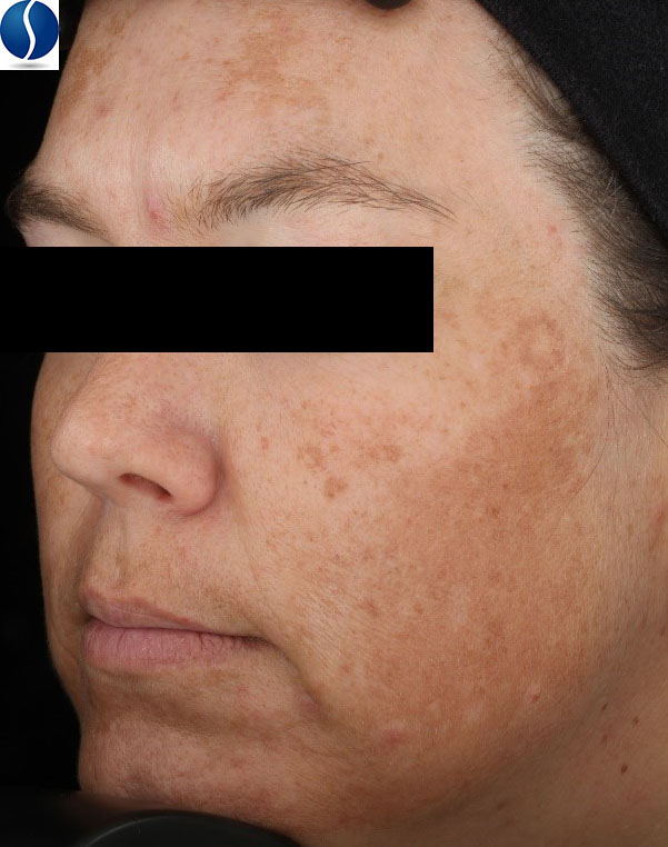 Skin Conditions - SGS Clinical Studies