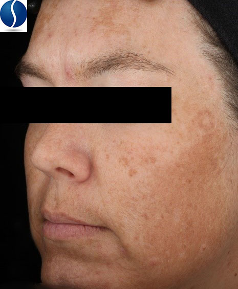 Skin Conditions - SGS Clinical Studies